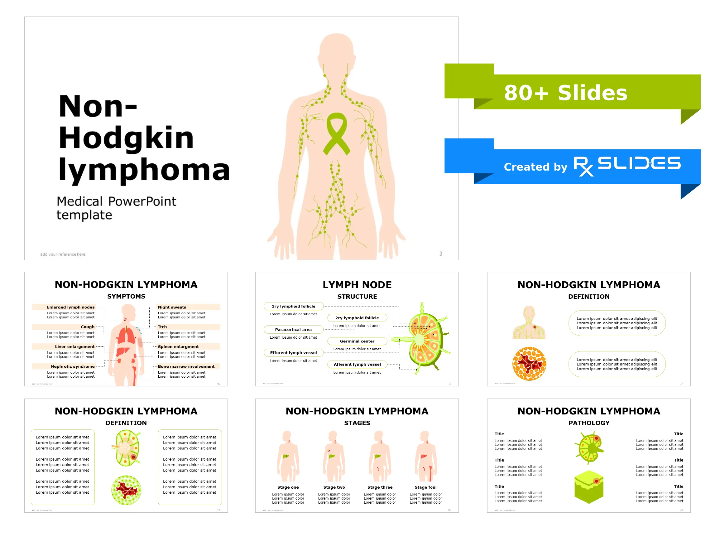 Download Non Hodgkin's lymphoma PowerPoint Template | RxSlides